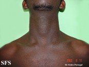 Acanthosis Nigricans (Dark Thick Skin Folds) Causes and Pictures ...
