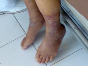 Five Common Reasons for Burning Feet with Tests and Treatments - Healthhype
