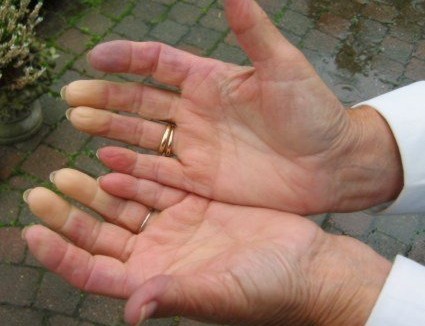 Hand Cramps (Spasms) Causes and Symptoms - Healthhype