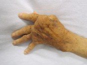Rheumatoid Arthritis (Joint Arthritis, Nodules and Deformities ...