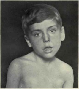 Torticollis - Symptoms and Treatment - Healthhype