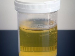 Cloudy Urine Causes And What Does Murky Urine Mean? - Healthhype