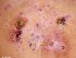 Rosacea (Red Skin Rash) Causes, Phases, Pictures, Treatment ...