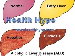 9 Signs of Liver Toxicity (Toxic Hepatitis) - Healthhype