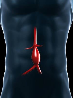 Aortic Dissection (Tear in Aorta) Causes, Symptoms, Treatment - Healthhype