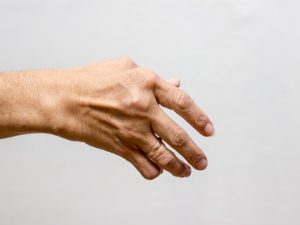 Hand Cramps (Spasms) Causes and Symptoms - Healthhype