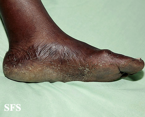 Athlete's Foot (Ringworm) Tinea Pedis Causes, Pictures, Treatment ...
