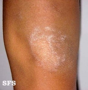 Peeling Skin Problems, Pictures and Causes - Healthhype