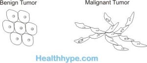 Characteristics of Benign and Malignant Tumors - Healthhype