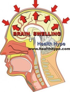 Pressure on the Brain - Process, Causes and Symptoms - Healthhype