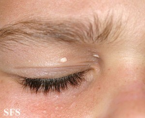 Calcinosis Cutis (Calcium Deposits in the Skin) - Healthhype