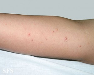 Calcinosis Cutis (Calcium Deposits in the Skin) - Healthhype