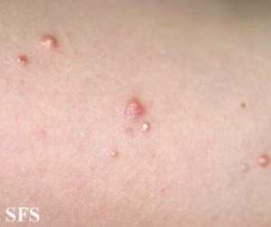 Calcinosis Cutis (Calcium Deposits in the Skin) - Healthhype