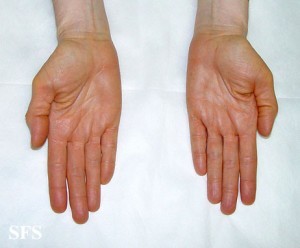 Causes and Treatment of Palmar Hyperhidrosis - Sweaty Palms/Hands ...