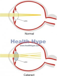Blurry Vision and Cloudy or Hazy Vision - Healthhype