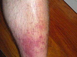 7 Signs of Cellulitis (Infection Under the Skin) - Healthhype