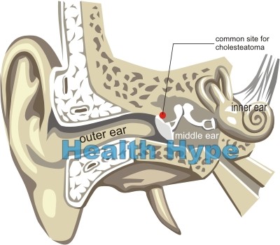 Cholesteatoma Meaning, Symptoms, Recurrence, Surgery, Video ...