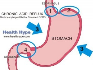 Reflux When Lying Down Causes, Remedies and Treatment - Healthhype