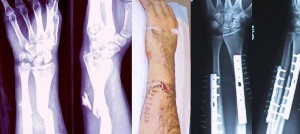 Compound Fractures - Causes and Types - Healthhype