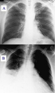 Consolidation of Lung - Signs, Symptoms and Causes - Healthhype