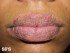 Rash Around Mouth (Lips) Causes, Pictures, Treatment | Healthhype.com