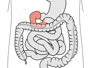 Pain in Peptic Ulcers (Stomach, Duodenum) - Healthhype
