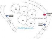 Edema (Swelling) and Anasarca (Generalized Body Swelling) - Healthhype