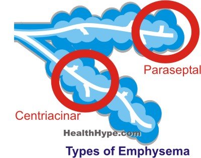Emphysema (Smoker’s Lung) Early to Late, Types, Duration Smoking ...