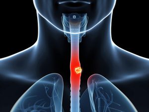 Blockage in the Esophagus - Causes of Esophageal Obstruction - Healthhype