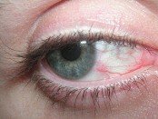 Eye Mucus (Excessive & Crusty) - Causes and Symptoms - Healthhype