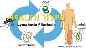 Elephantiasis (Elephantitis) Disease, Types, Pictures, Treatment ...