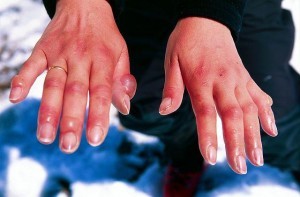 Cold Injury (Freezing and Non-Freezing Damage) - Healthhype