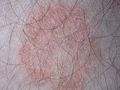 jock itch | Healthhype.com