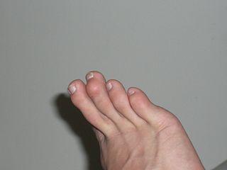 Hammer, Claw and Mallet Toe (Abnormally Bent Toes) - Healthhype