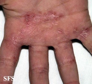 Tinea Manuum (Hand Fungus) Causes, Symptoms, Pictures, Treatment ...