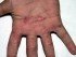 Tinea Manuum (Hand Fungus) Causes, Symptoms, Pictures, Treatment ...