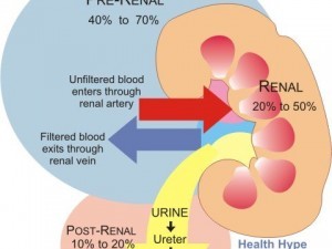 Floating Kidney (Nephroptosis) - Healthhype