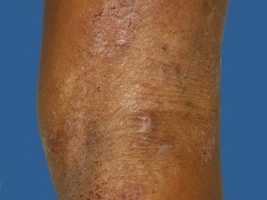rash behind knees and elbows Archives - Healthhype