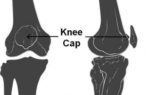 Knee Cap Pain and Types of Kneecap Injury - Healthhype