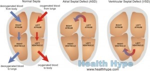 Left-to-Right Cardiac Shunts (Heart) Types and Symptoms - Healthhype