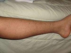 Cold Legs - Causes of Lower Leg Coldness with Pain and Aches - Healthhype