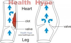 Swollen Calf Muscles - Causes of Swelling of Back of Lower Leg - Healthhype