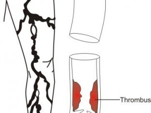 7 Signs of a Blood Clot and What It Looks and Feels Like - Healthhype