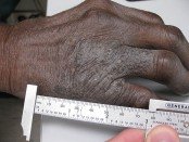 Neurodermatitis (Lichen Simplex Chronicus) Chronic Scratch Rash ...