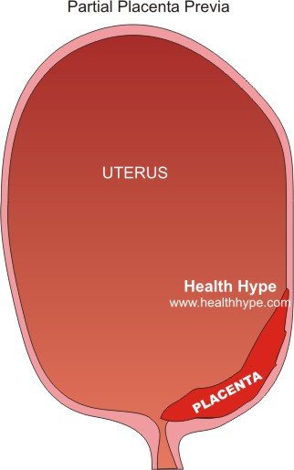 Placenta Problems - Infected Placenta and Low Placenta (Previa ...