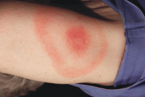 Lyme Disease (Borrelia burgdorferi Bacteria) - Healthhype