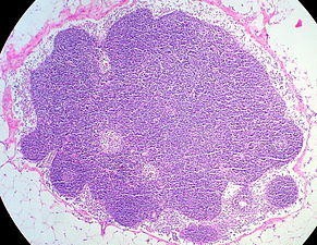 Swollen Armpit Lymph Nodes - Causes of Enlarged Axillary Glands ...