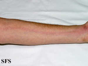 Lymphangitis (Infected Lymphatic Vessels) - Healthhype