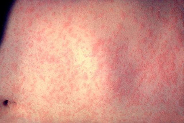 Measles - Spread, Symptoms, Pictures, Treatment, Prevention - Healthhype