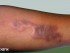 Morphea (Hardened Skin Disease) - Healthhype